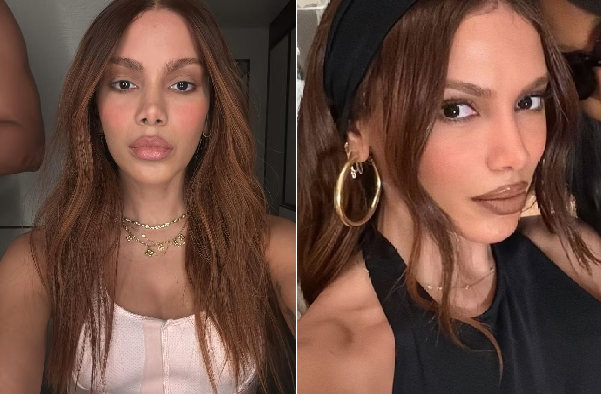 O tenso bastidor de Anitta após plástica: procedimento de Michael ...